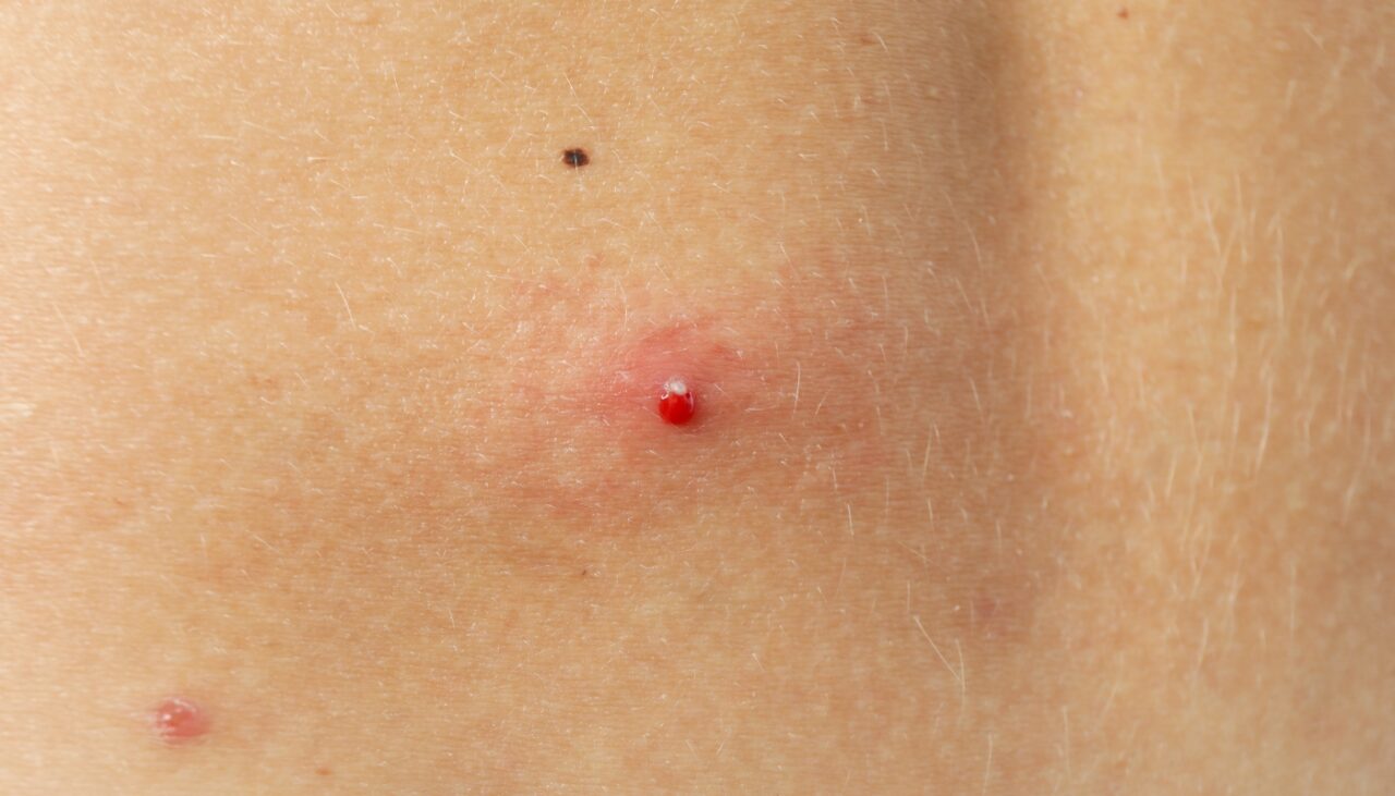 Pintas vermelhas na pele: o que são essas bolinhas? - Tá Saudável